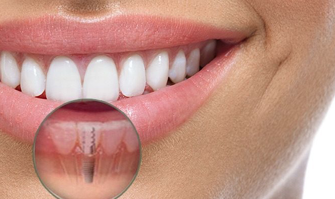 Qualidade em implante dentário. Agende sua consulta | GOU Odonto